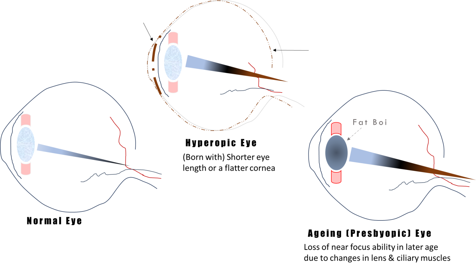 Reading and Understanding an Ocular Prescription - Stan Isaacs Ortho K ...