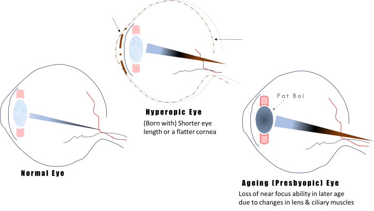 Reading and Understanding an Ocular Prescription - Stan Isaacs Ortho K ...