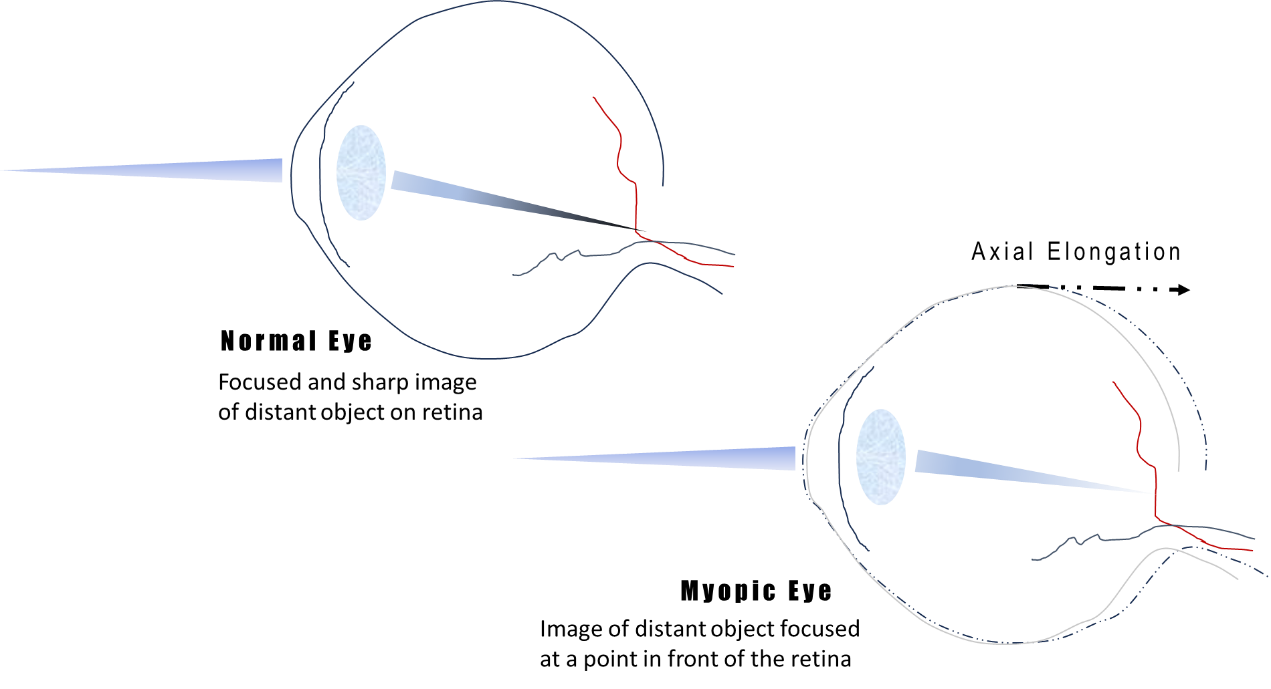 Reading and Understanding an Ocular Prescription - Stan Isaacs Ortho K ...